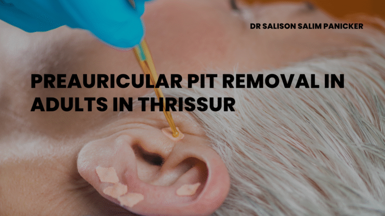 Preauricular pit removal in adults in thrissur - Dr Salison Salim Panicker